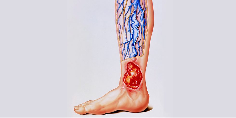 Úlceras Vasculares | Cid Vieira